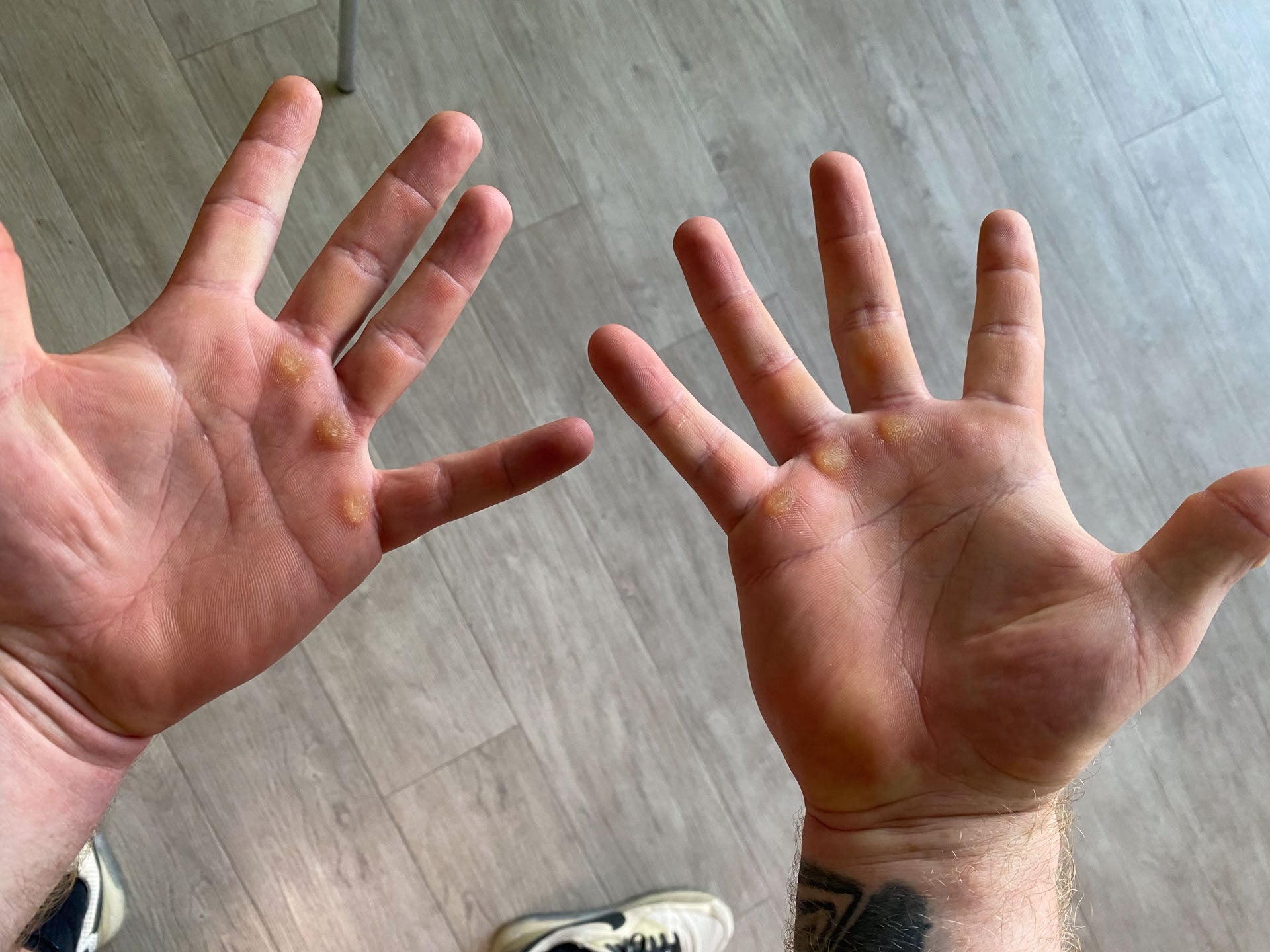 How to Remove Calluses on Hands: A Comprehensive Guide – Lopalmed